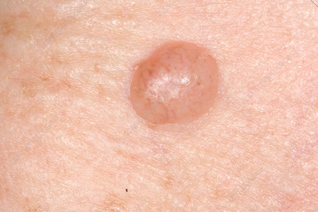 Junctional Naevus Mole On The Skin Stock Image C013 Junctional naevus ...